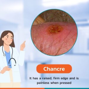 Syphilis Chancres : How to Distinguish and Treat Effectively
